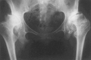 Zmiany zwyrodnieniowe stawu biodrowego – Koksartroza | Vivamedica
